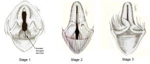 Laryngeal Collapse - Melbourne Bulldog Clinic